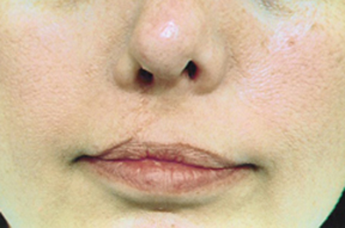 Finding the Missing Ingredient in Many Cleft Lip Repairs