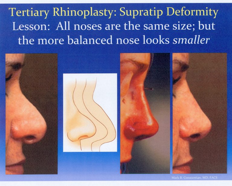 Why Doesn’t My Nose Look Like The Simulation That The Doctor Created ...