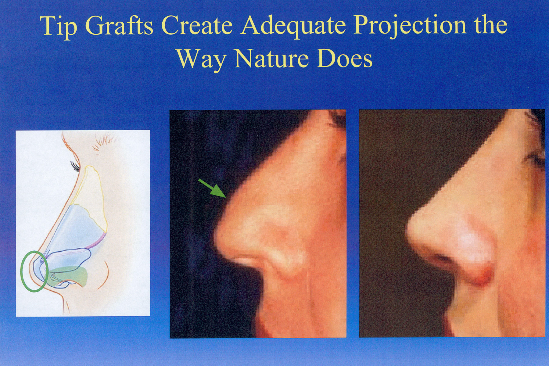 What Is Tip Projection and How Do You Improve It? – Part II